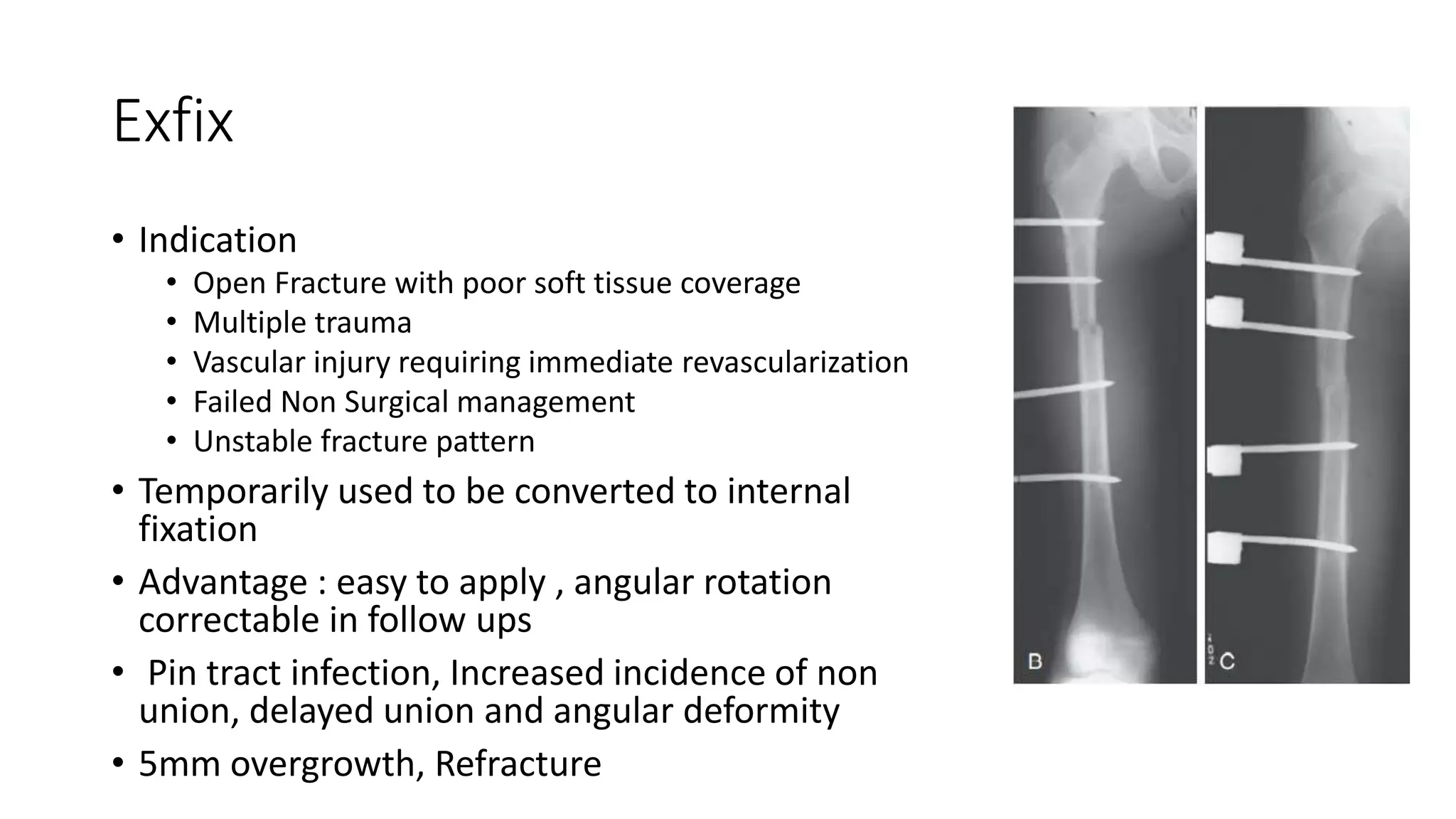 Pediatric Long Bone Fractures.pptx