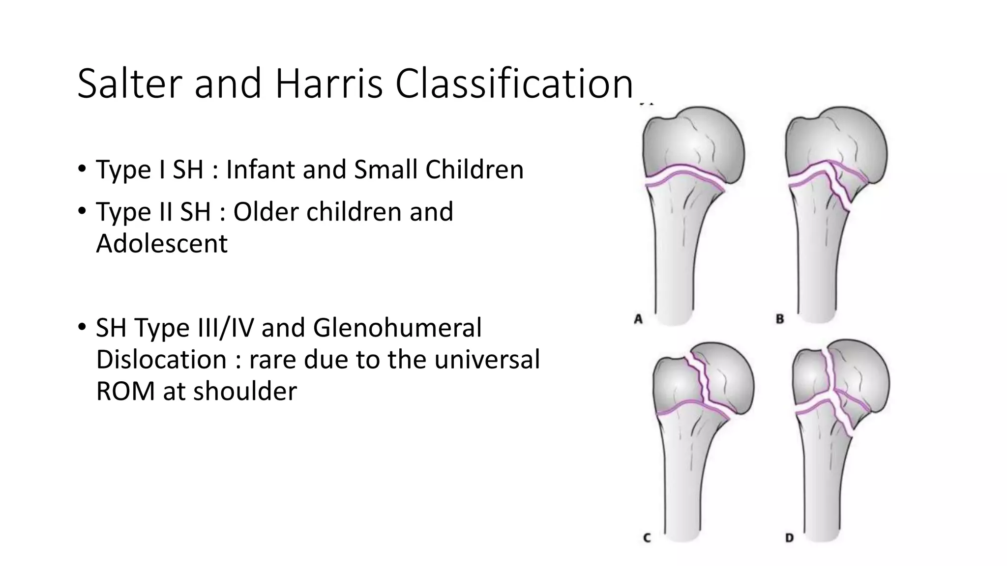 Pediatric Long Bone Fractures.pptx