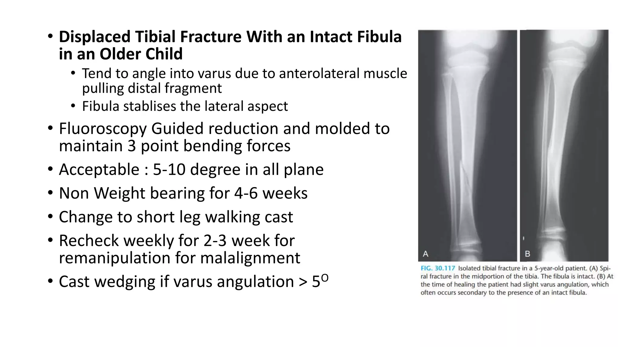 Pediatric Long Bone Fractures.pptx