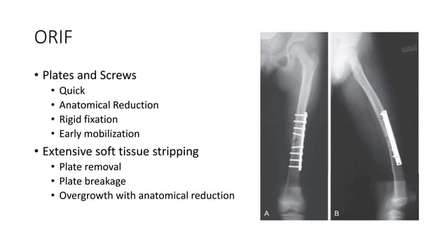 Pediatric Long Bone Fractures.pptx