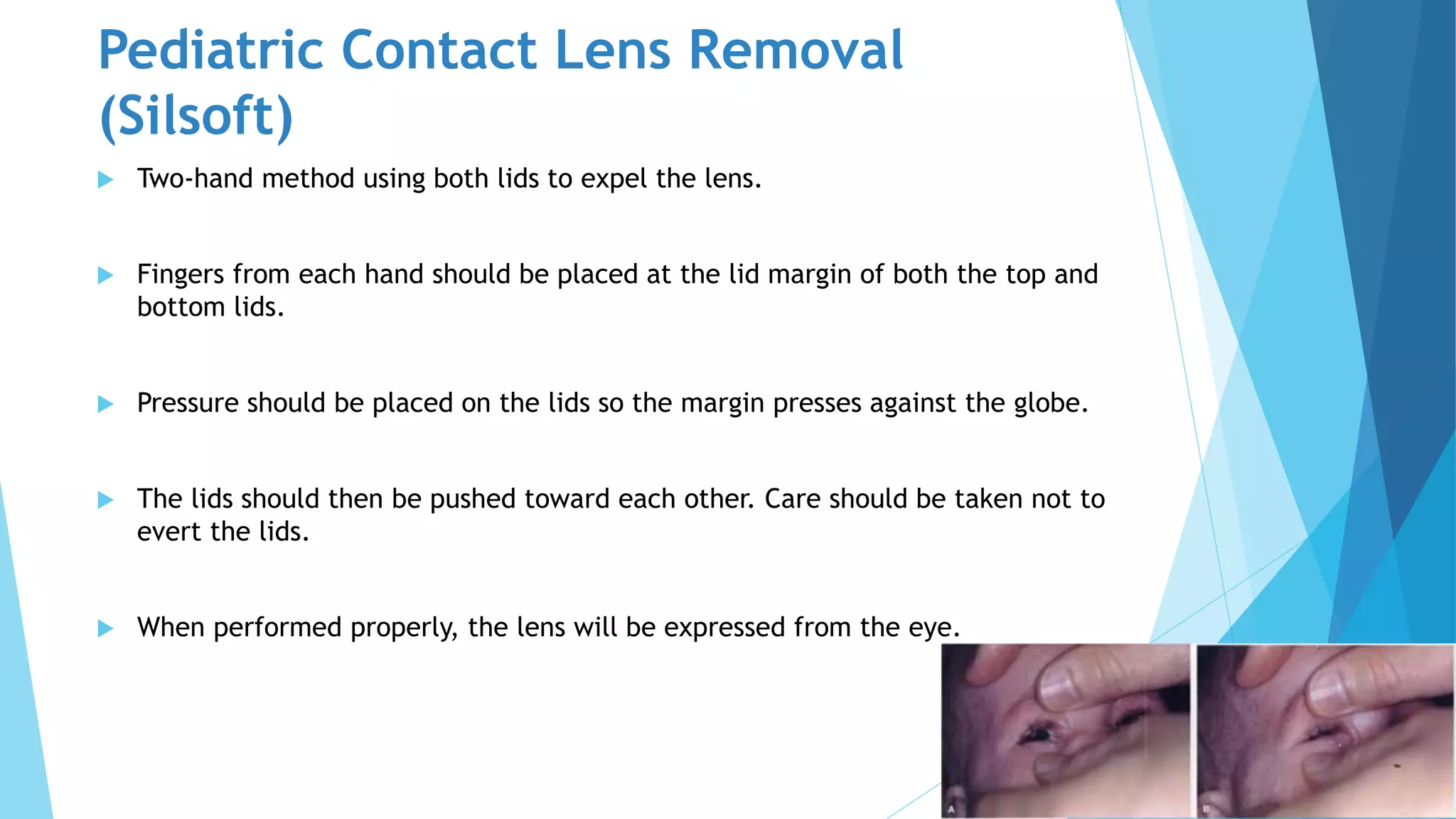 Pediatric management in contact lens-P82502 | PPTX