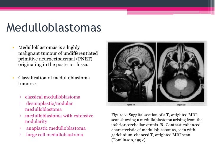 Pediatric medulloblastoma