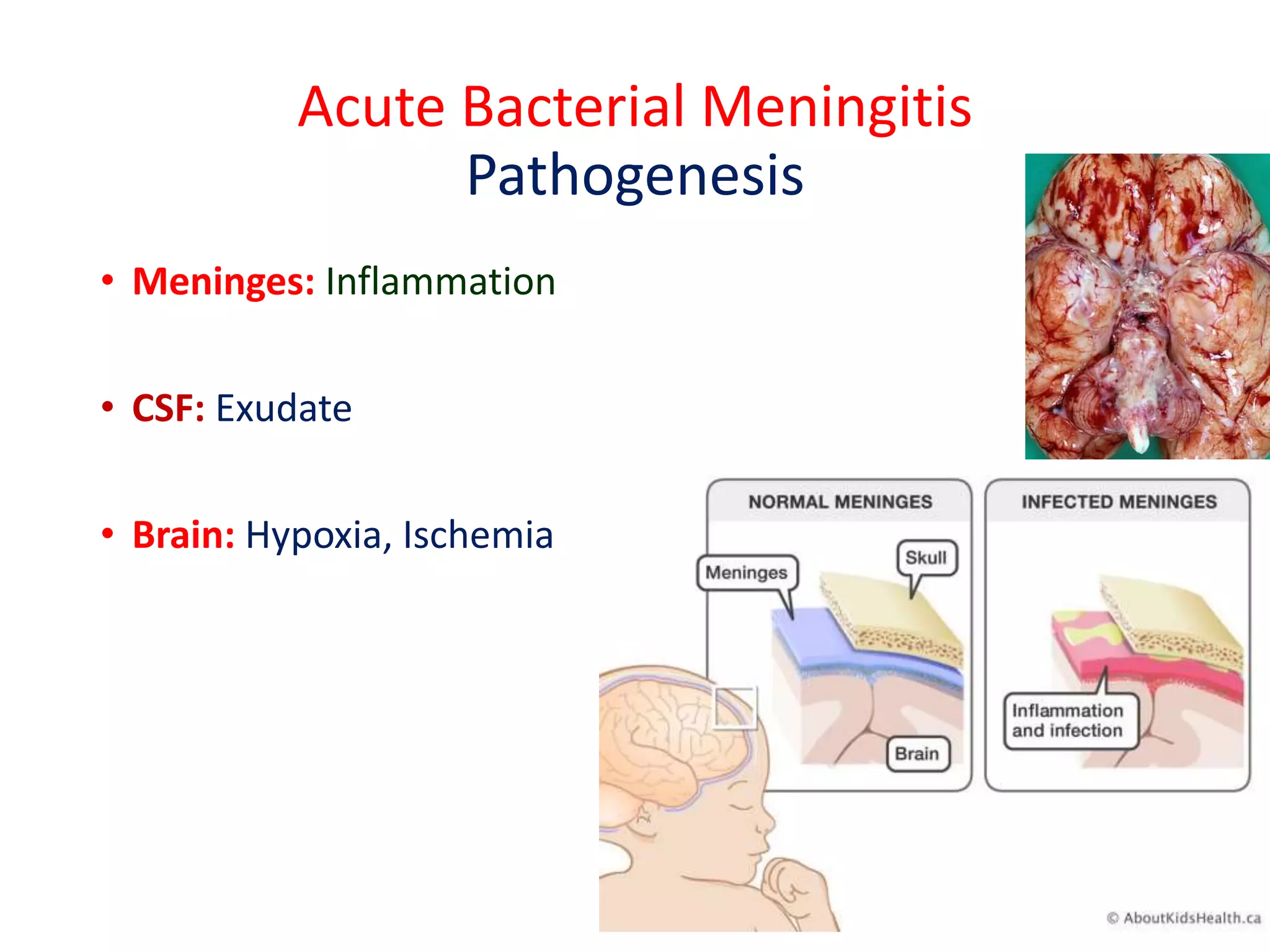 Pediatric meningitis and encephalitis 2021 | PPTX