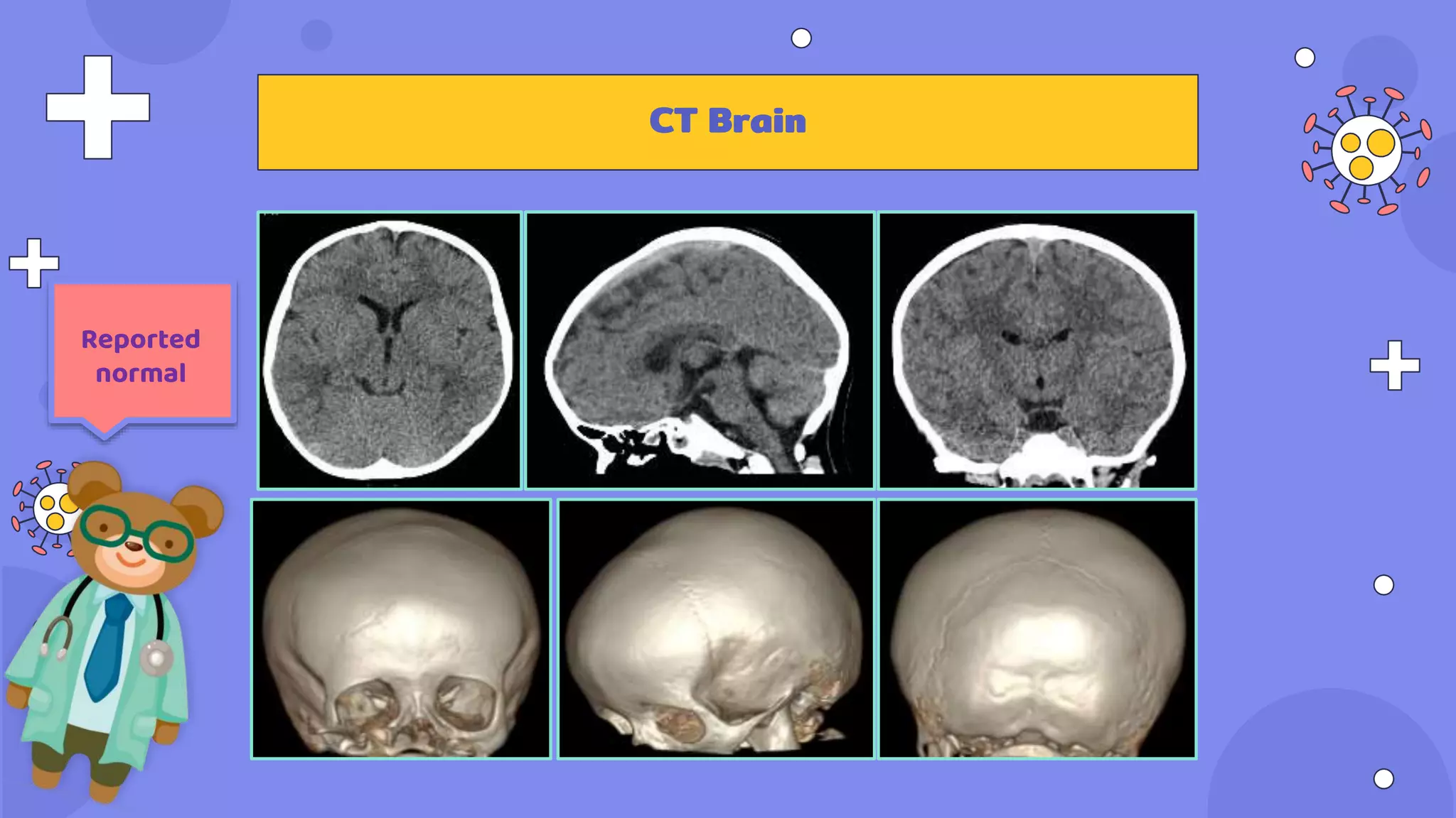 Pediatric Meningitis Case Presentation | PPTX