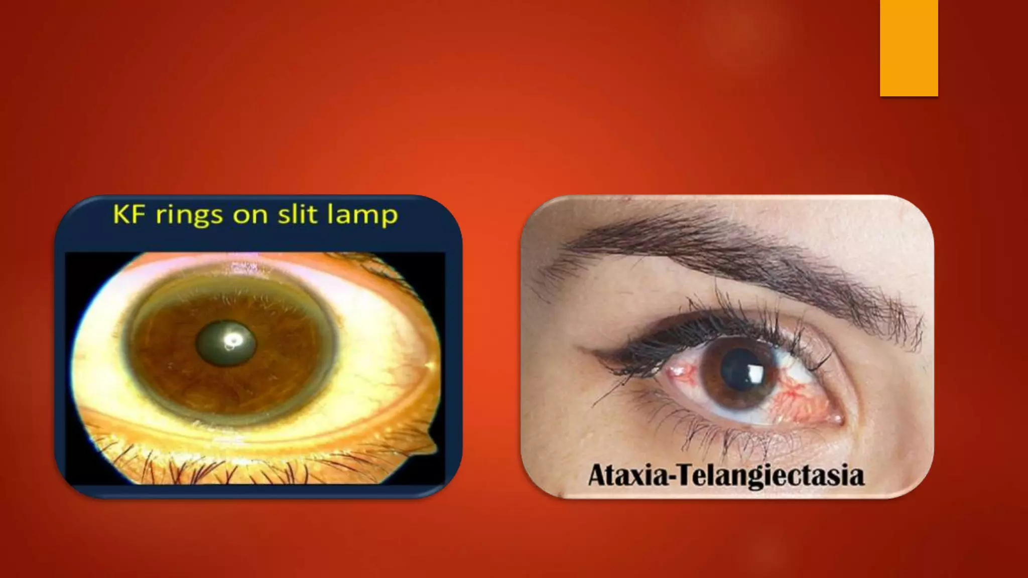 Pediatric movement disorders | PPTX