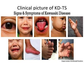 Pediatric multisystem inflammatory syndrome and kawasaki like disease ...