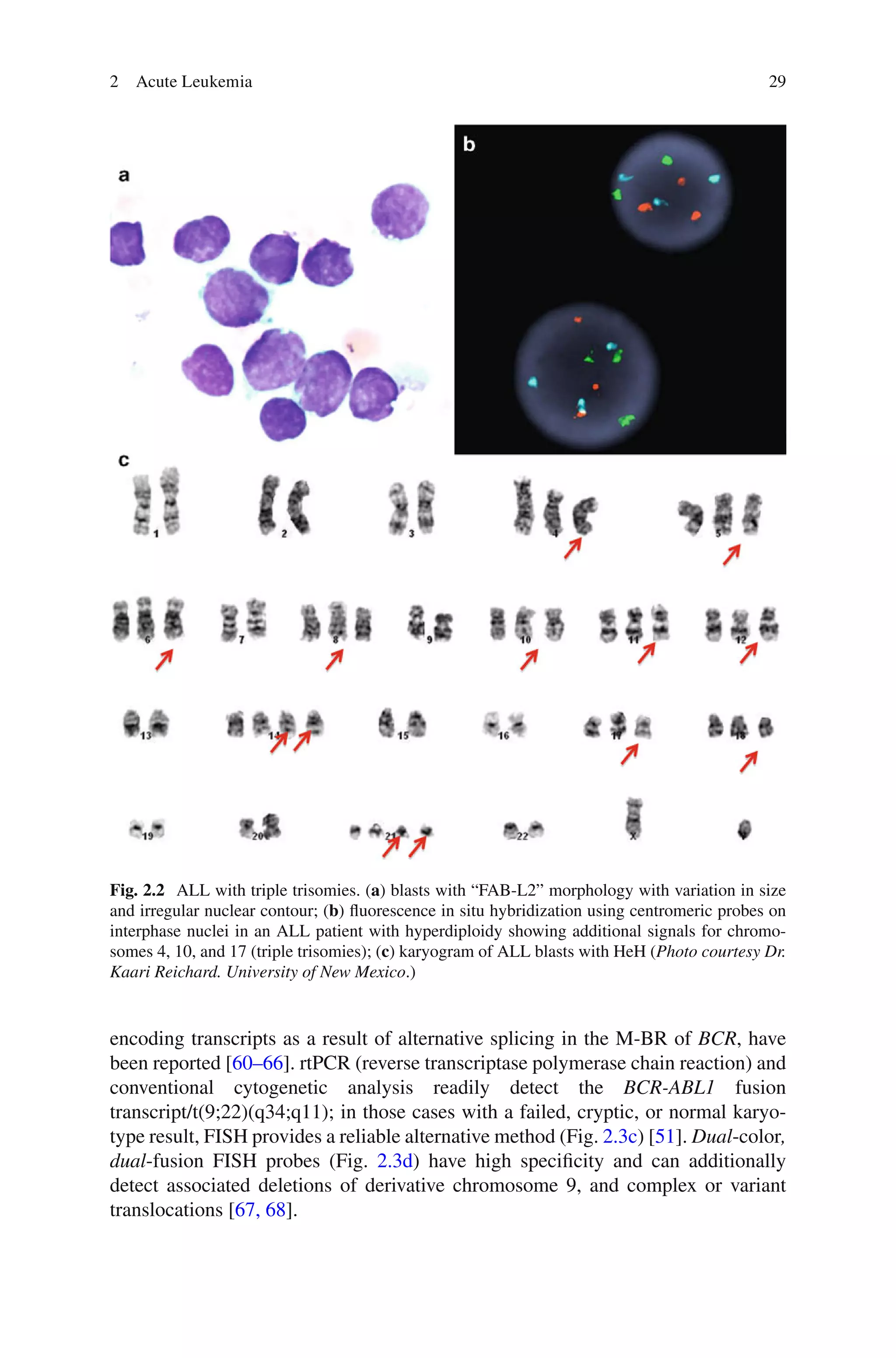 Pediatric neoplasia | PDF