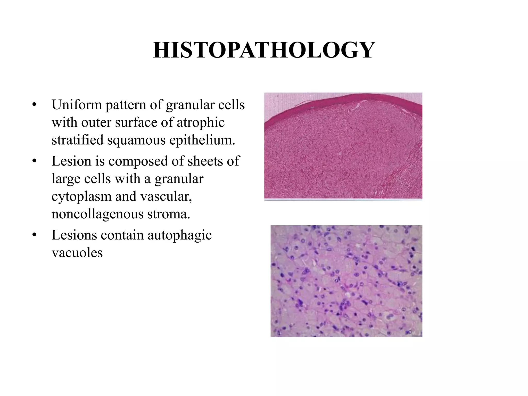 Pediatric neoplasm affecting the oral cavity | PPTX