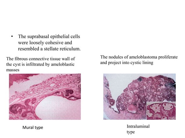 Pediatric neoplasm affecting the oral cavity | PPTX