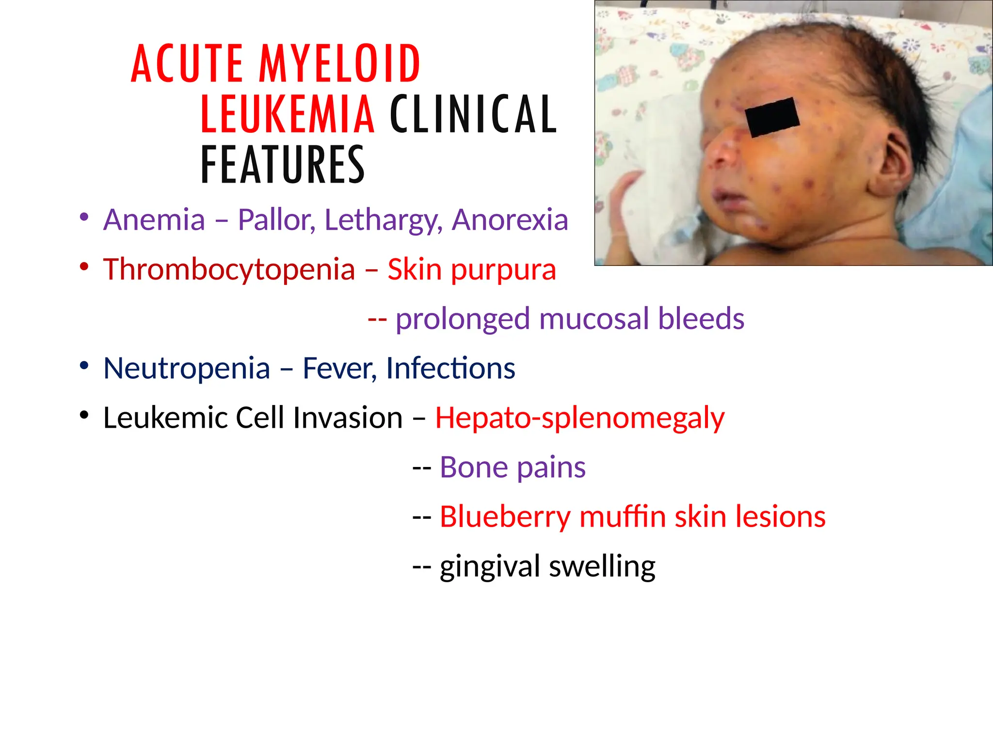 pediatric neoplastic disorders-ALL,AML,LYMPHOMAS | PPTX