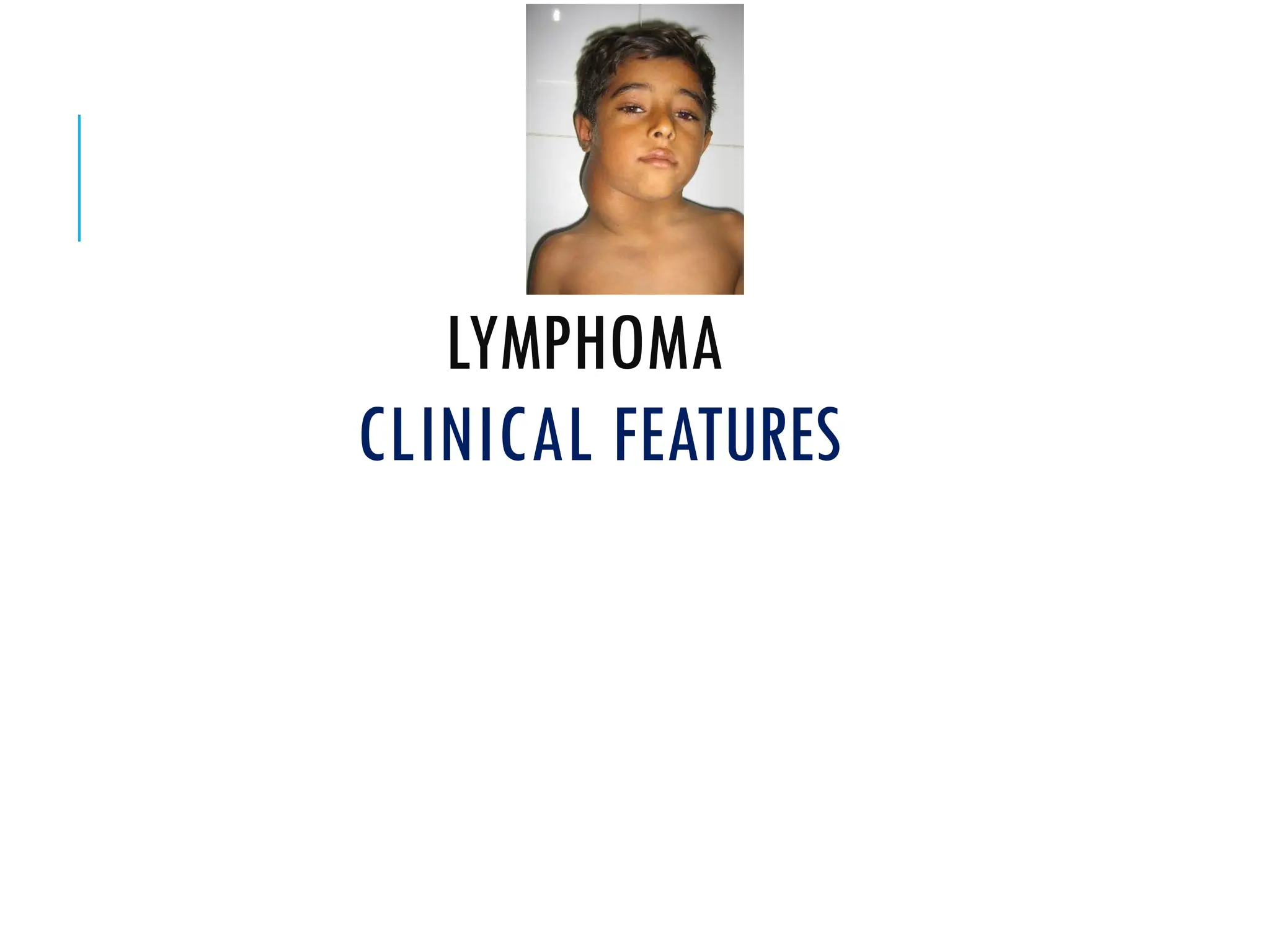 pediatric neoplastic disorders-ALL,AML,LYMPHOMAS | PPTX