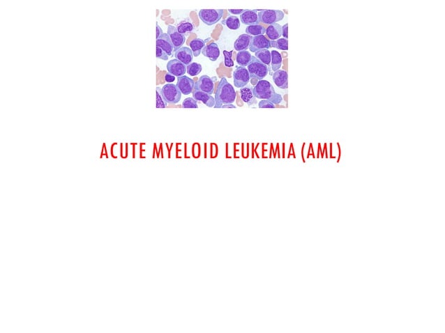 pediatric neoplastic disorders-ALL,AML,LYMPHOMAS | PPT | Free Download