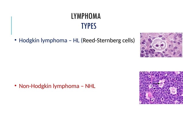 pediatric neoplastic disorders-ALL,AML,LYMPHOMAS | PPT