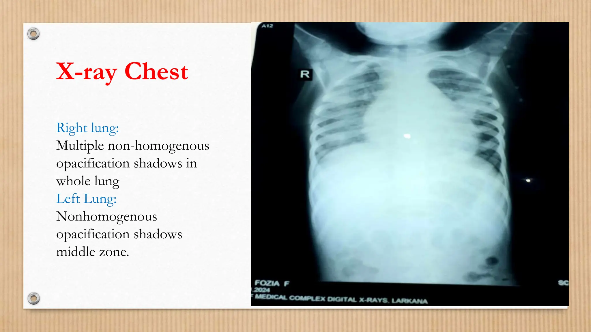 Pediatric Neurology. A presentation on stroke in pediatric case | PPTX