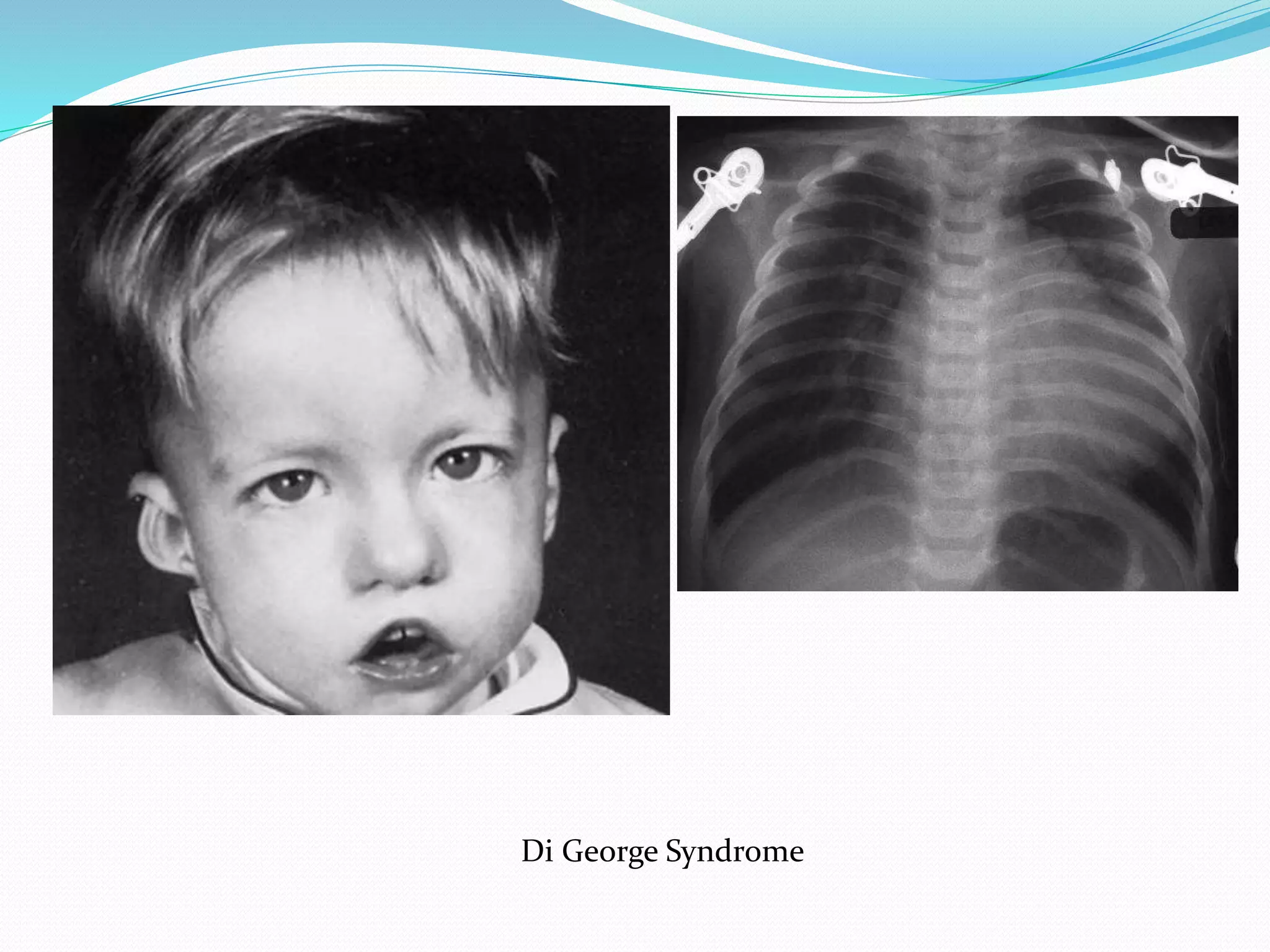 Pediatric neurology for ug part 1 | PPT