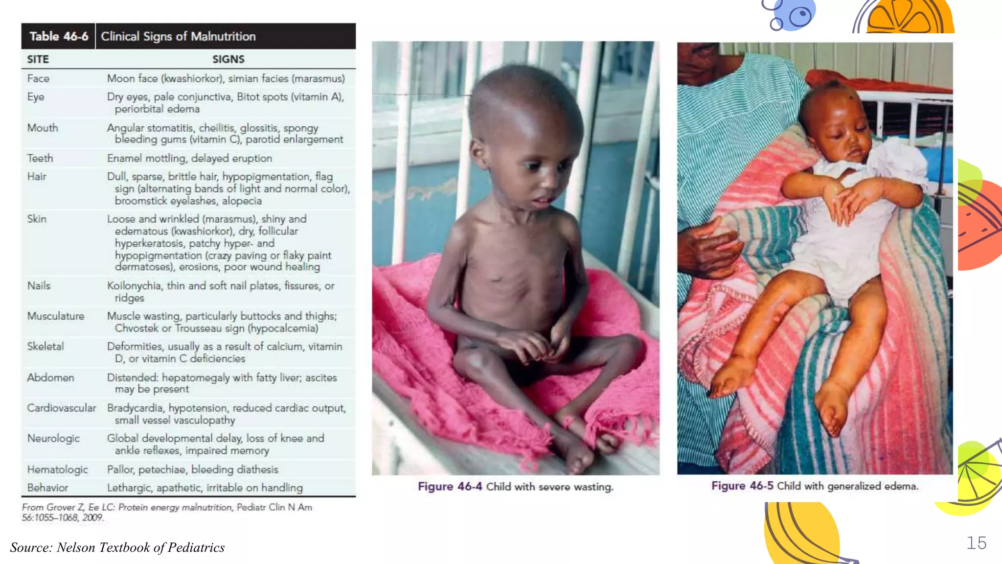 Pediatric Nutritional Deficiencies - Spot Diagnosis | PPT