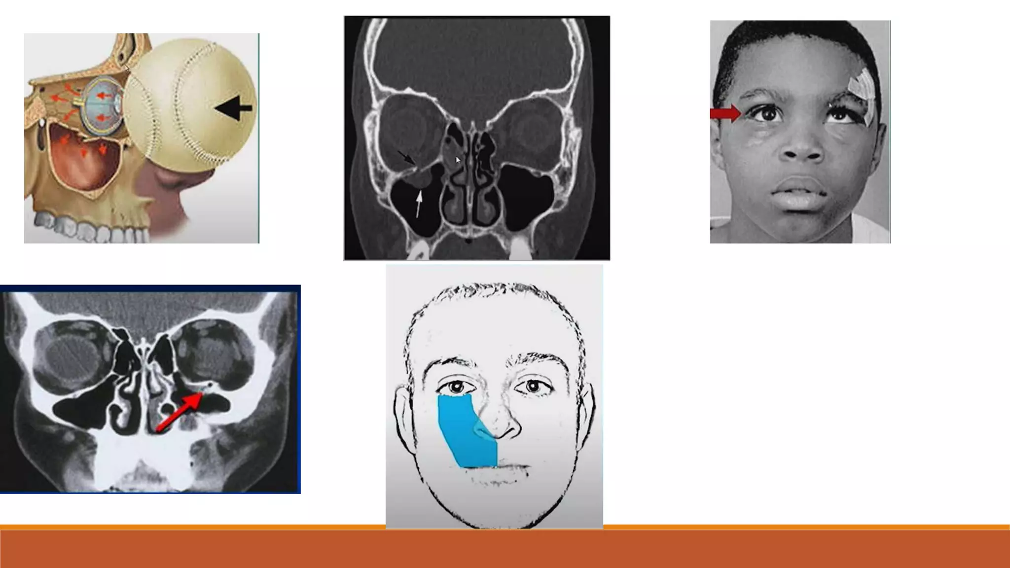 Pediatric Ocular Trauma.pptx