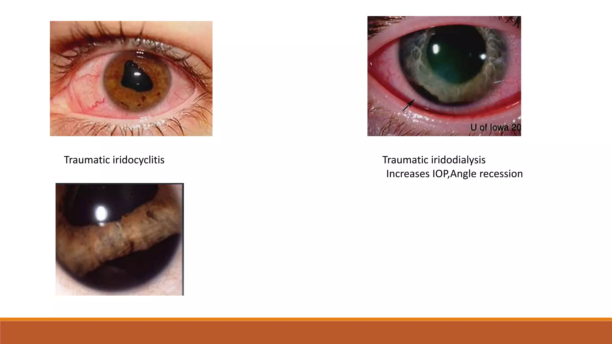 Pediatric Ocular Trauma.pptx