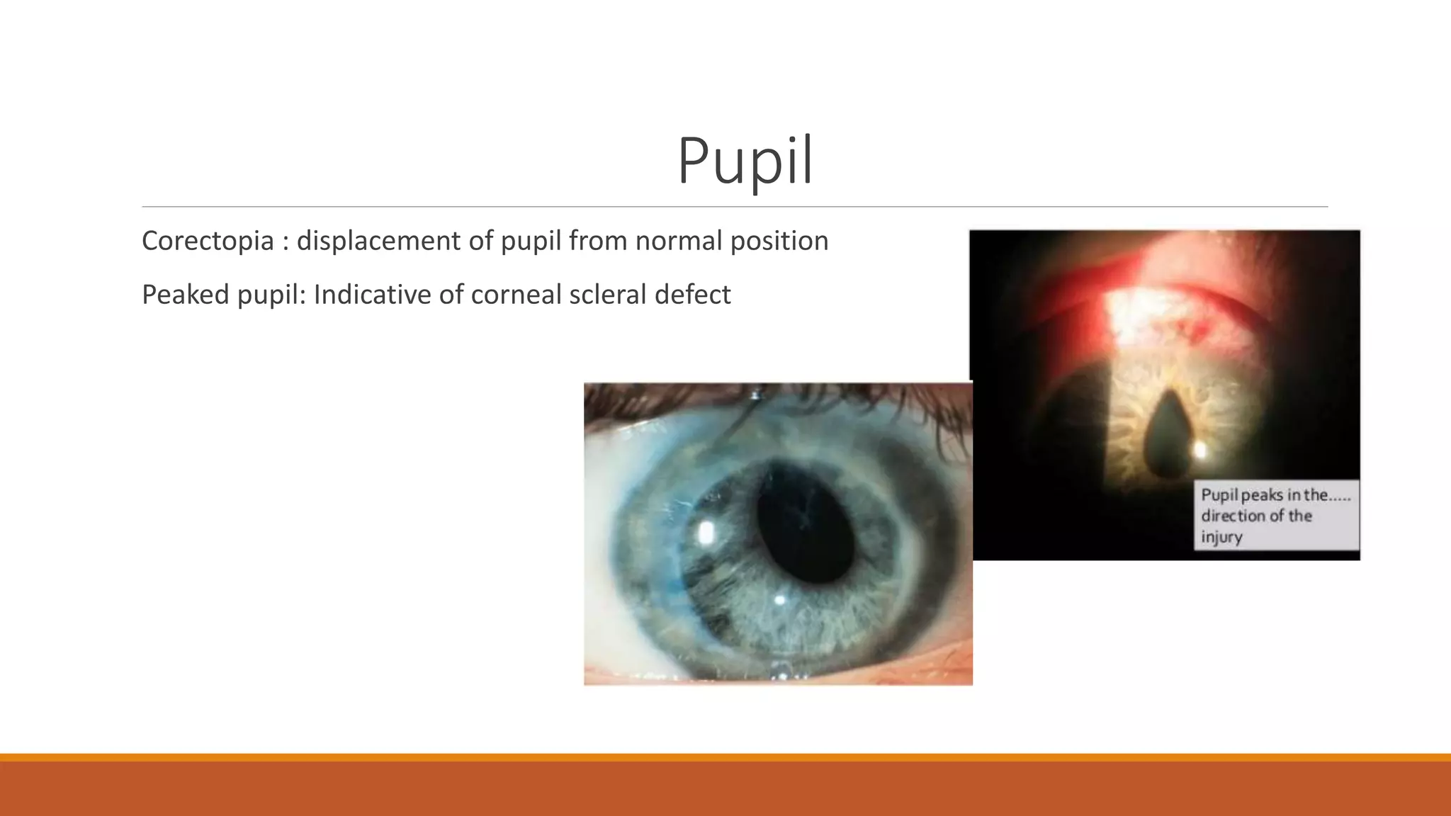 Pediatric Ocular Trauma.pptx