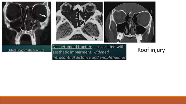 Pediatric Ocular Trauma.pptx