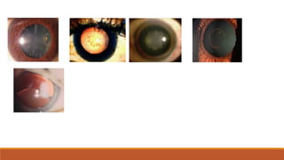 Pediatric Ocular Trauma.pptx