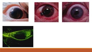 Pediatric Ocular Trauma.pptx