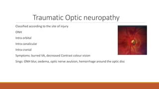 Pediatric Ocular Trauma.pptx