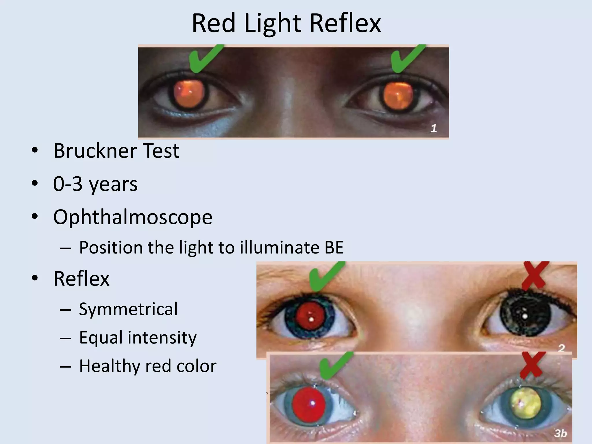 Vision Assessment and Vision Screening in Children, Refractive Error and Spectacle Correction ...