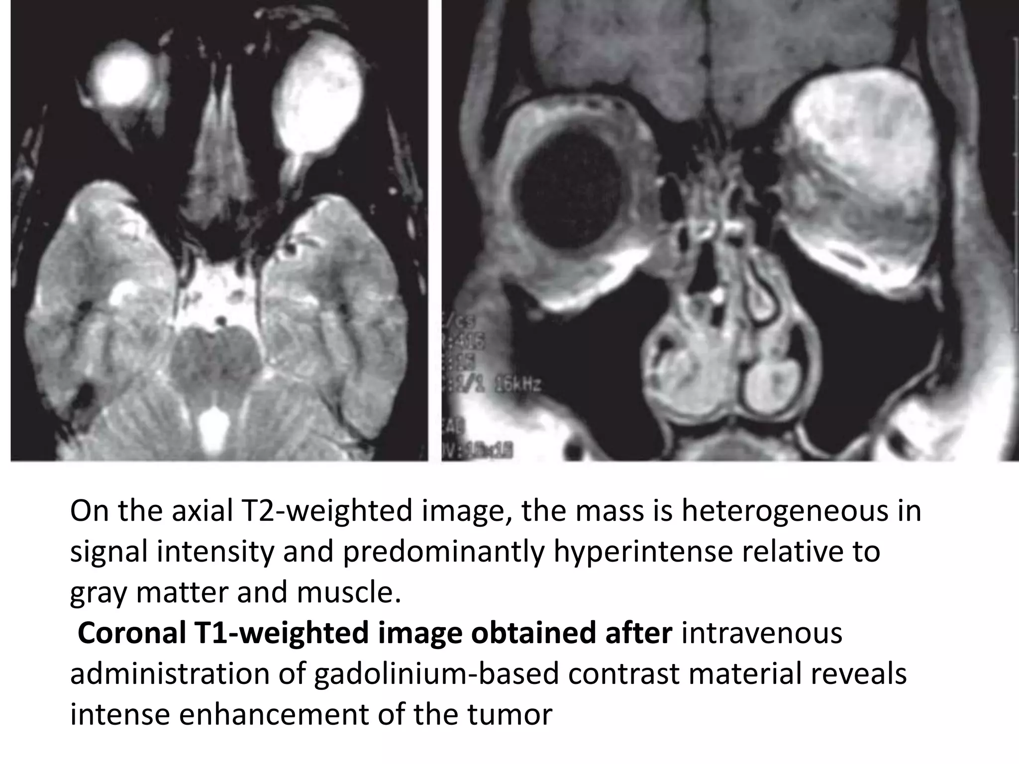 Pediatric orbit tumors and tumorlike | PPTX