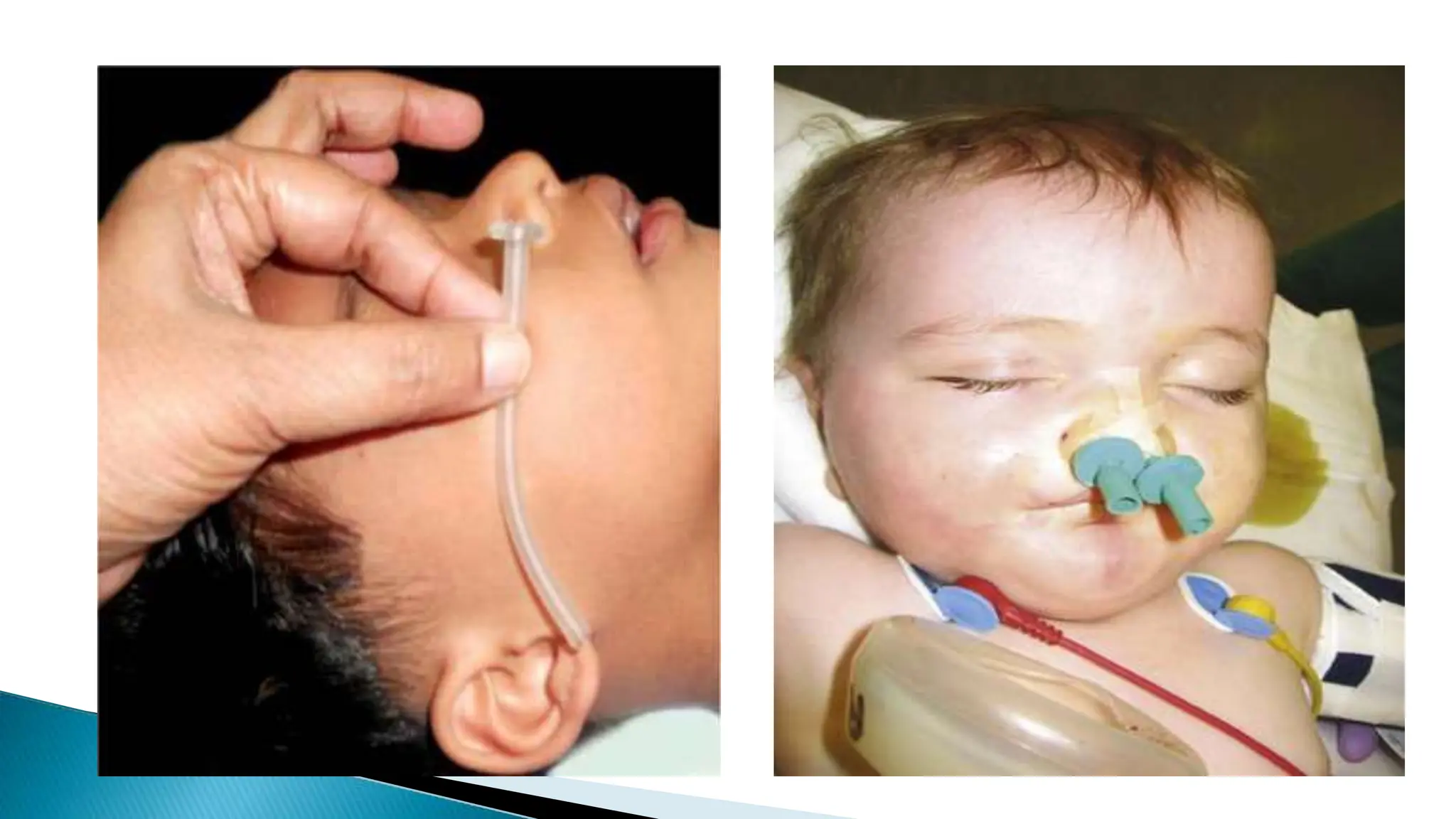 pediatric plastic anethesia cleft lip and palate.pptx