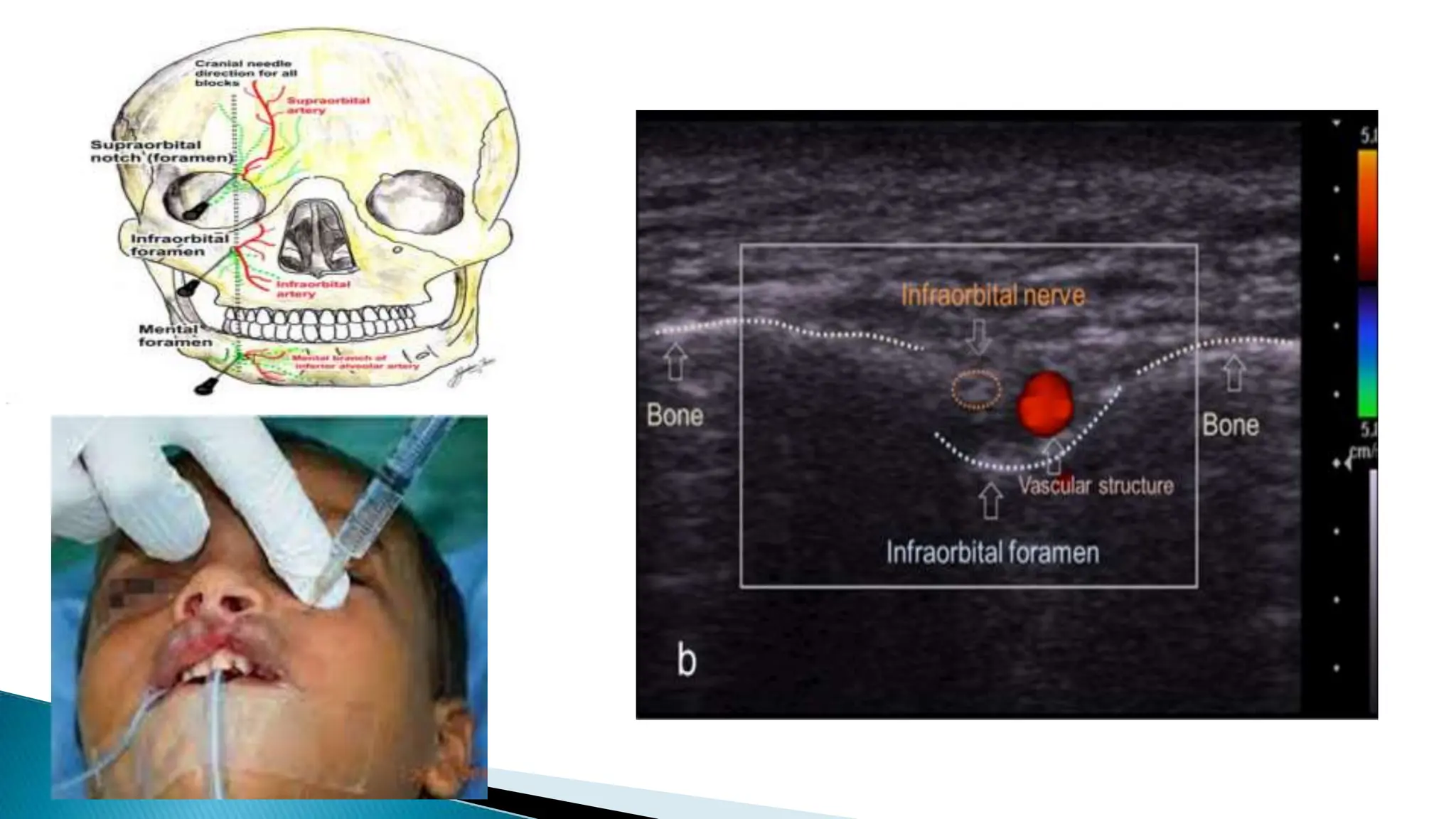 pediatric plastic anethesia cleft lip and palate.pptx