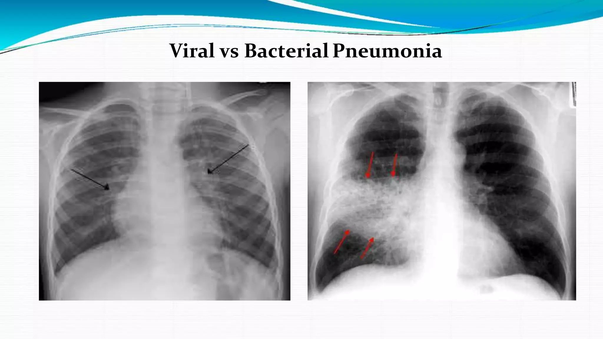 Pediatric pneumonia | PPTX