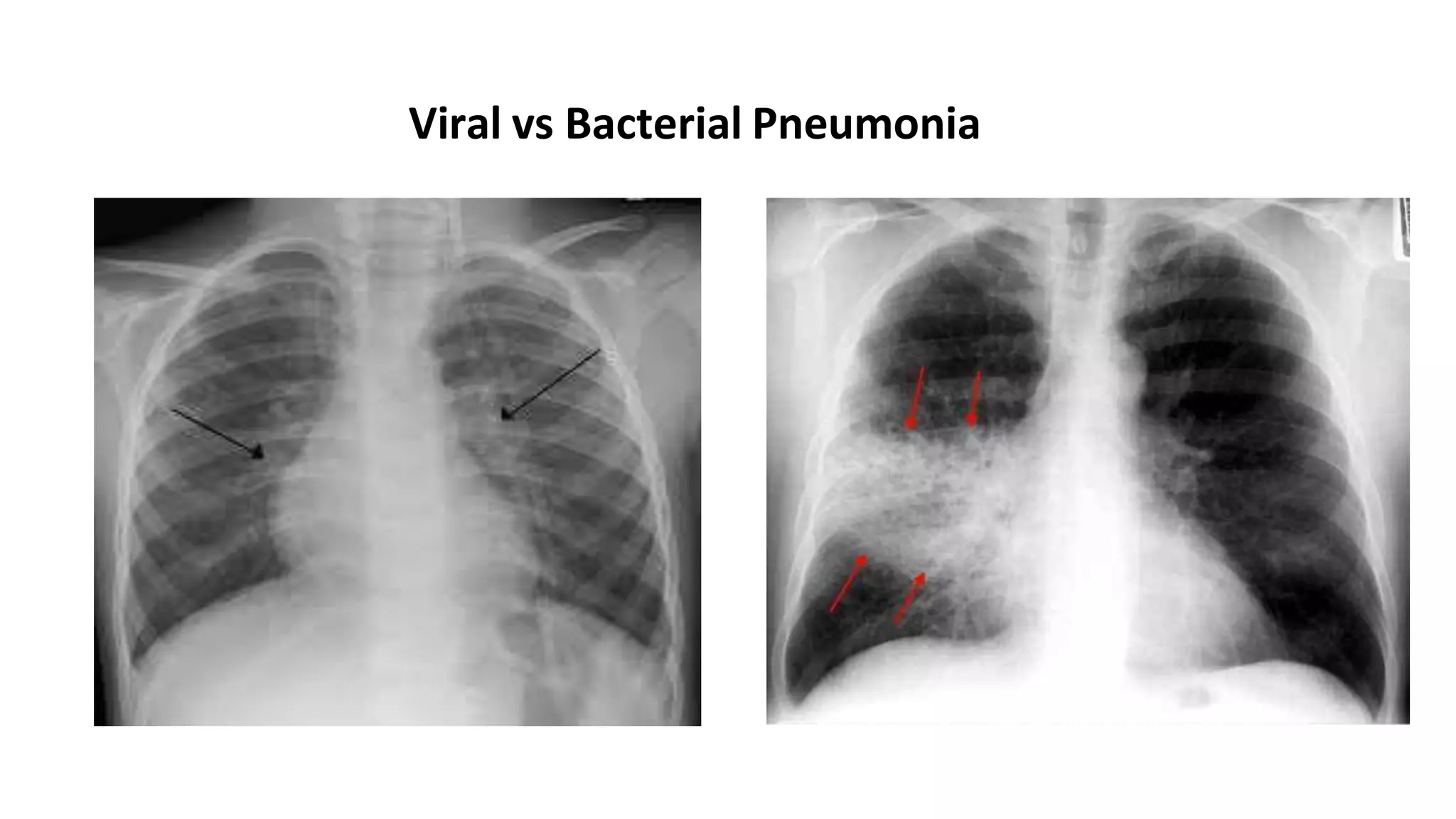 Pediatric pneumonia | PPTX