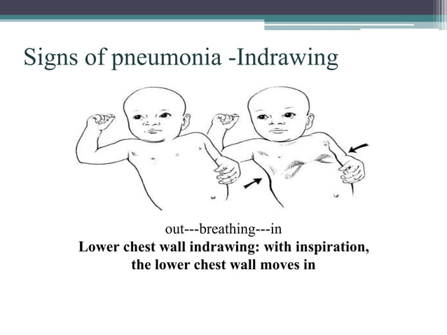 Pediatric pneumonia.pptx | Lung and Respiratory Health | Diseases and ...