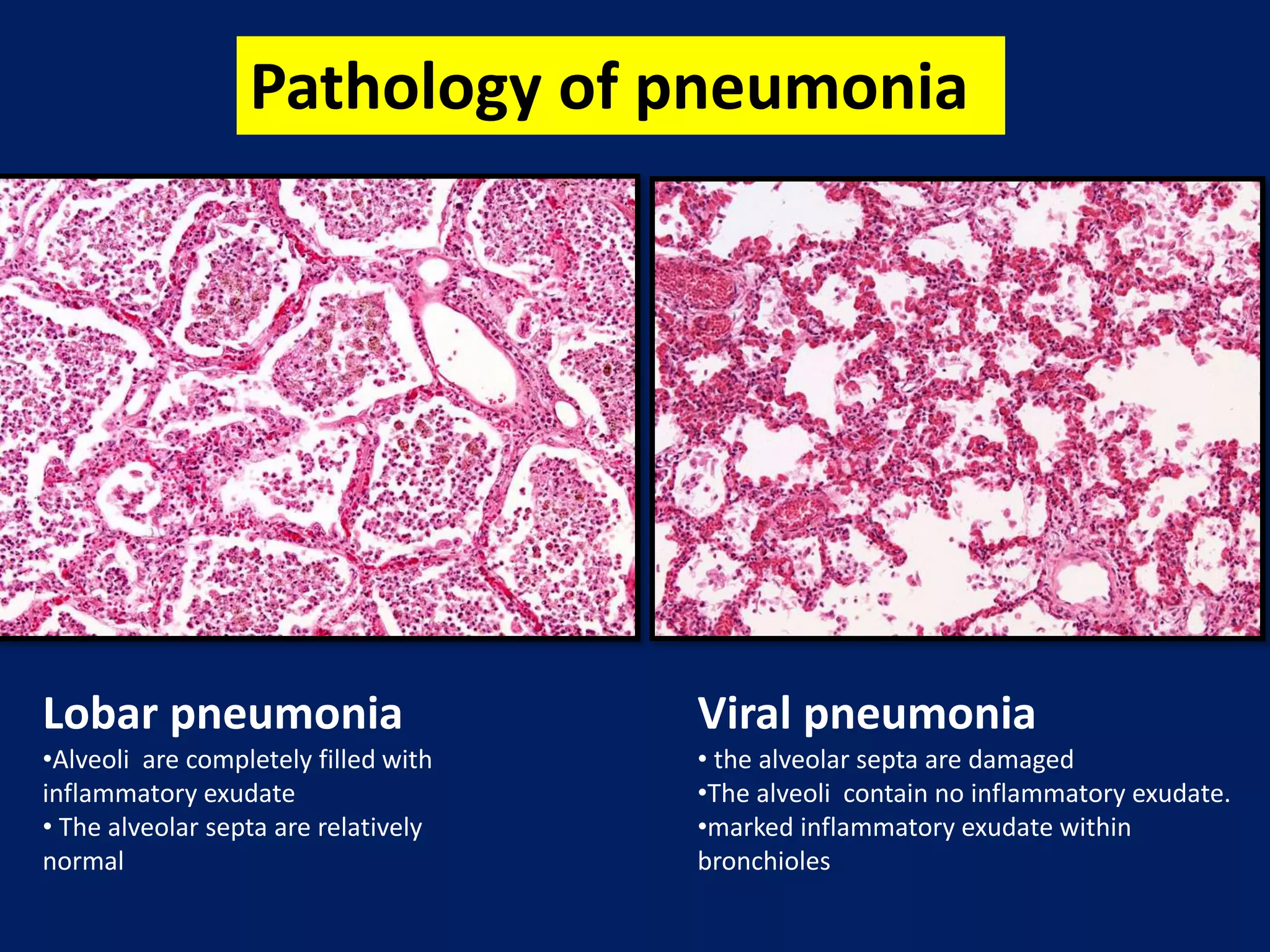 pediatric Pneumonia.pptx