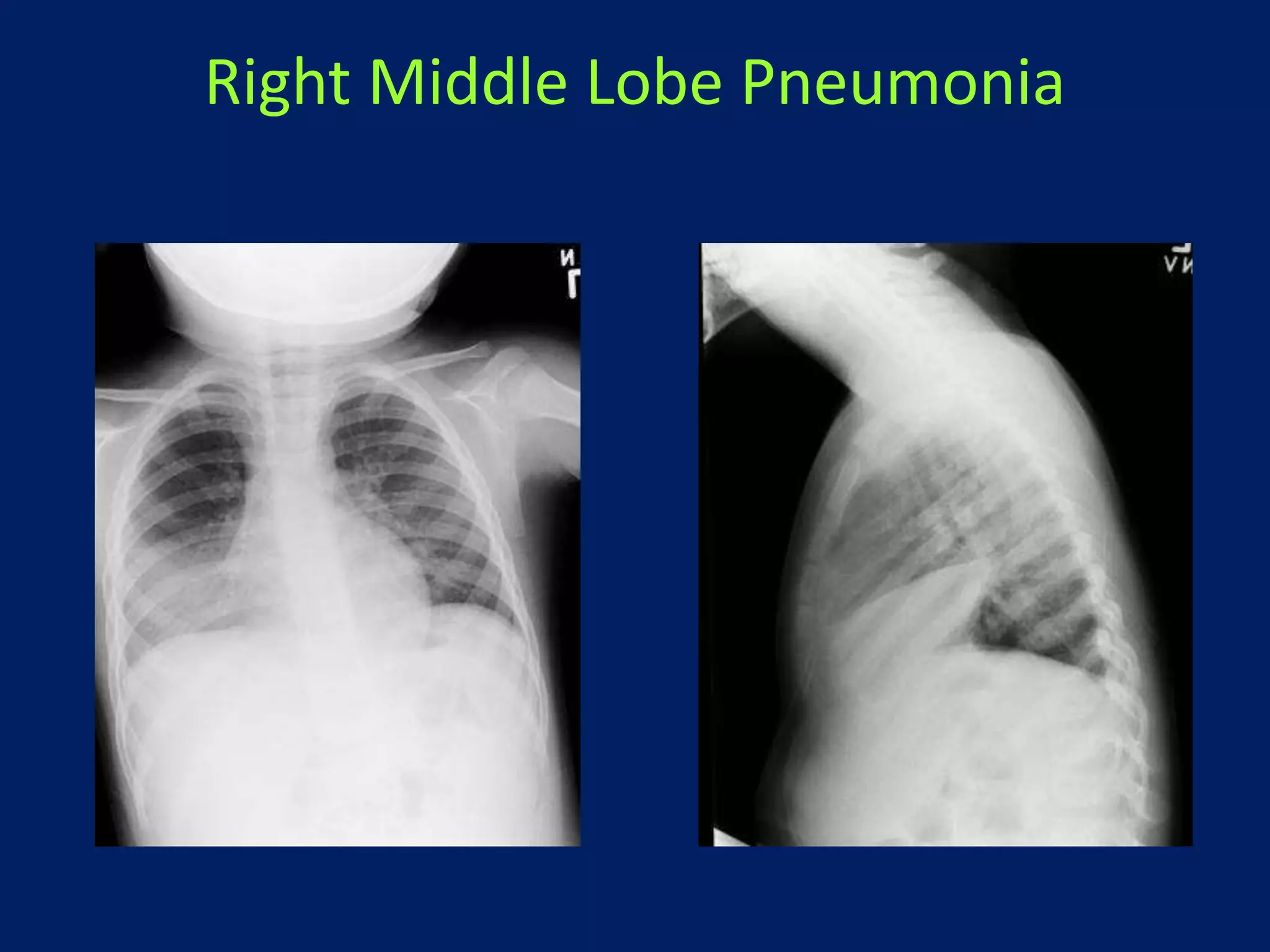 pediatric Pneumonia.pptx