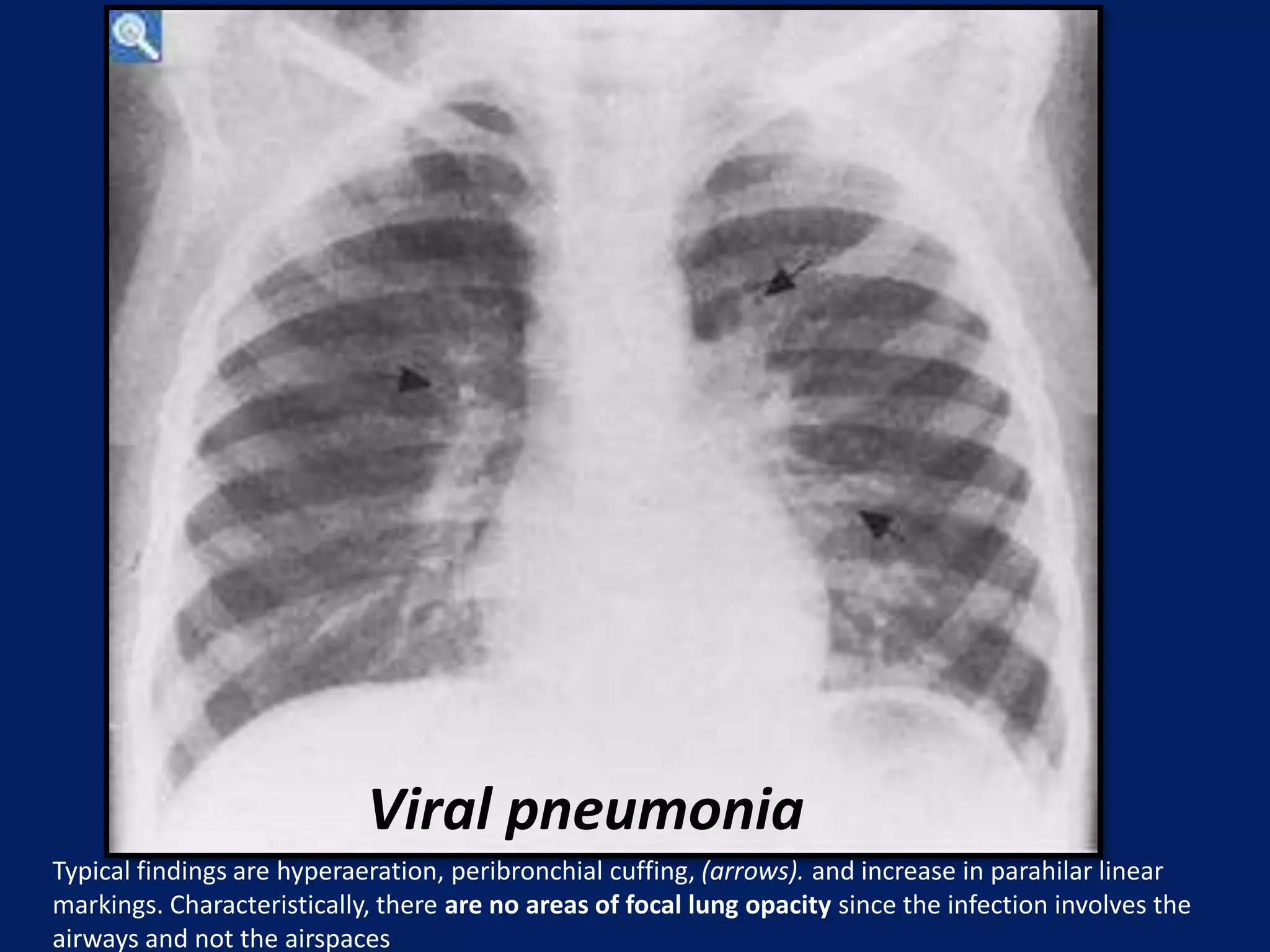 pediatric Pneumonia.pptx