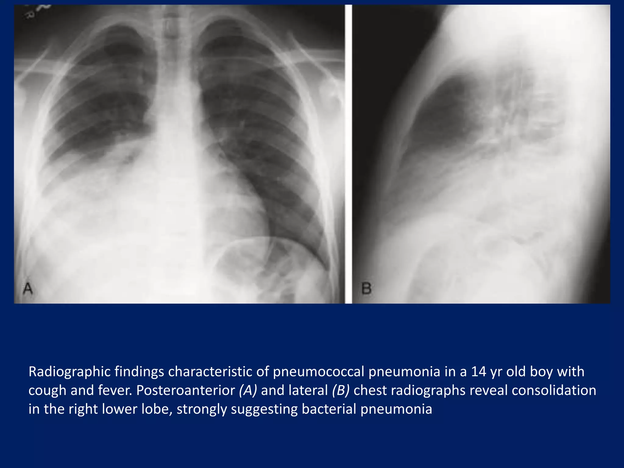 pediatric Pneumonia.pptx