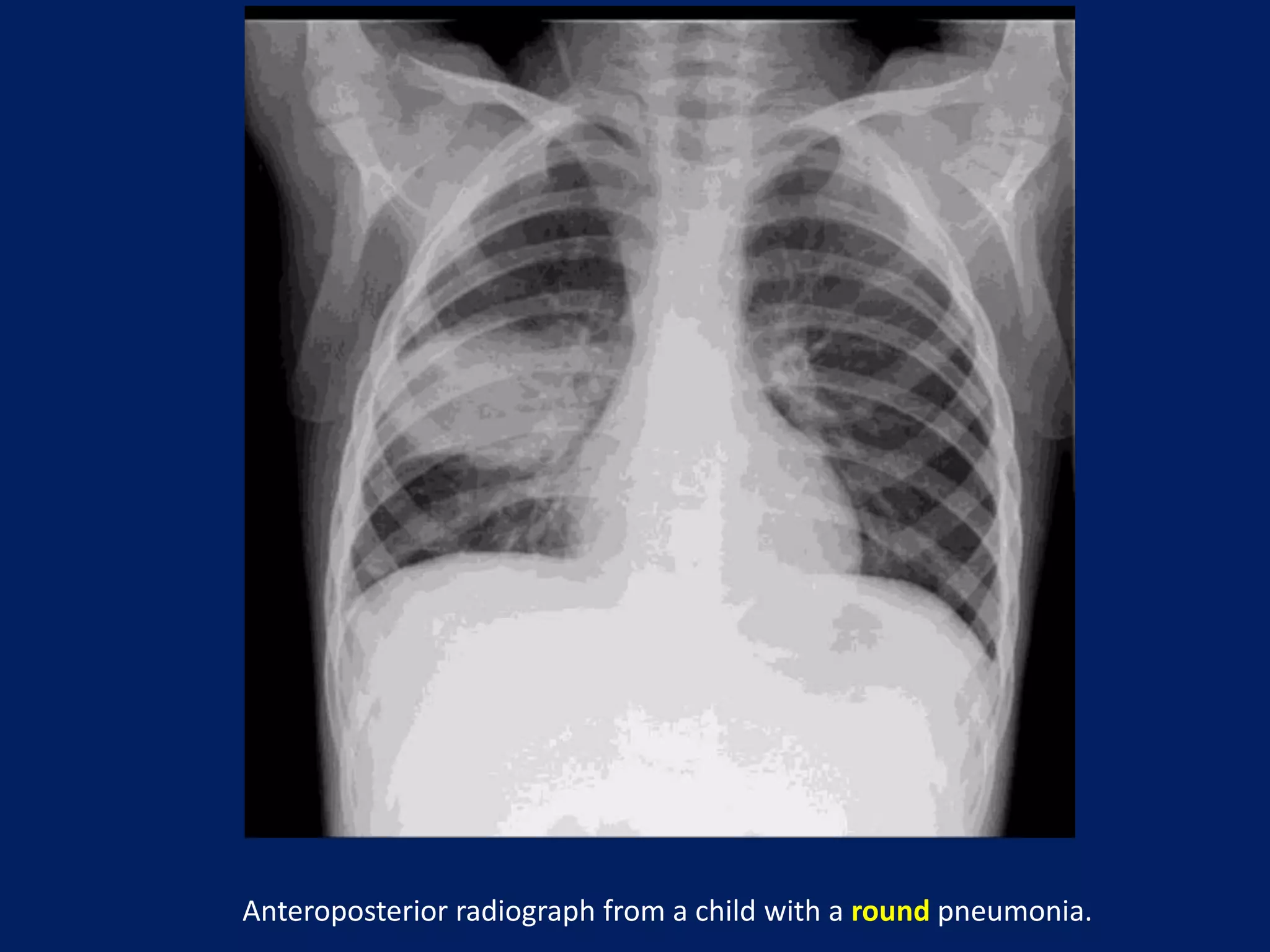 pediatric Pneumonia.pptx