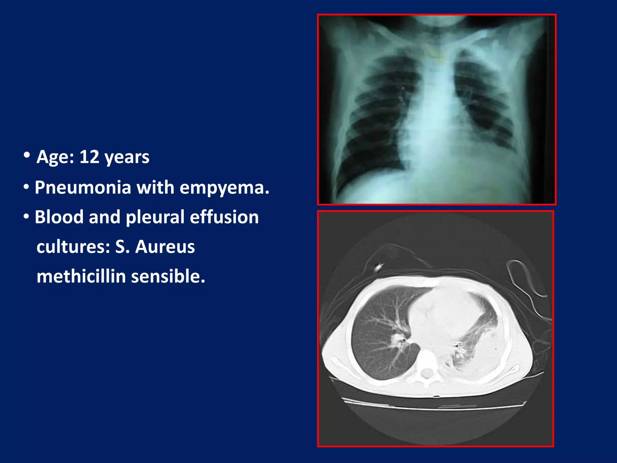 pediatric Pneumonia.pptx