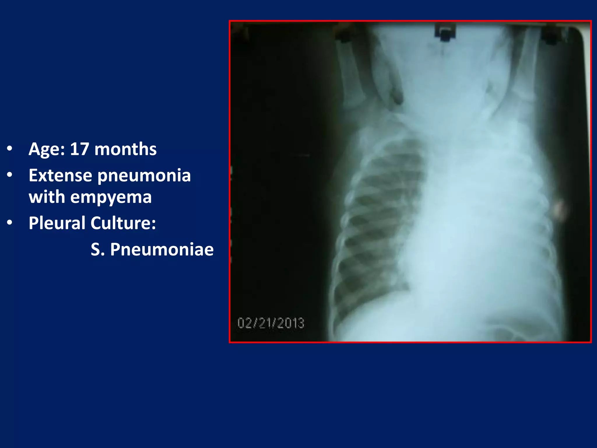 pediatric Pneumonia.pptx