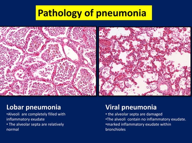 pediatric Pneumonia.pptx | Lung and Respiratory Health | Diseases and ...