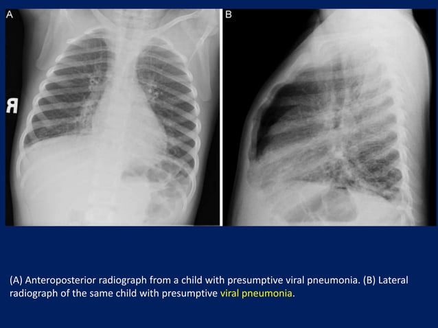 pediatric Pneumonia.pptx | Lung and Respiratory Health | Diseases and ...
