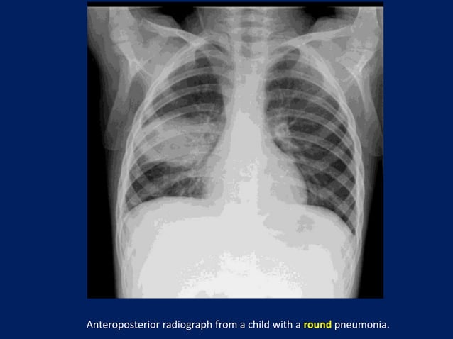 pediatric Pneumonia.pptx | Lung and Respiratory Health | Diseases and ...