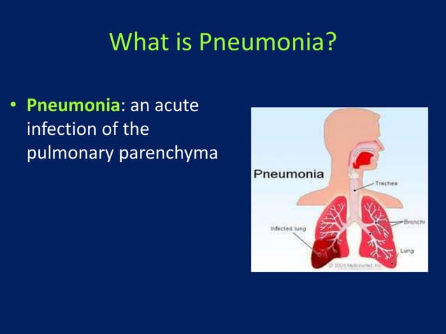 pediatric Pneumonia.pptx | Lung and Respiratory Health | Diseases and ...