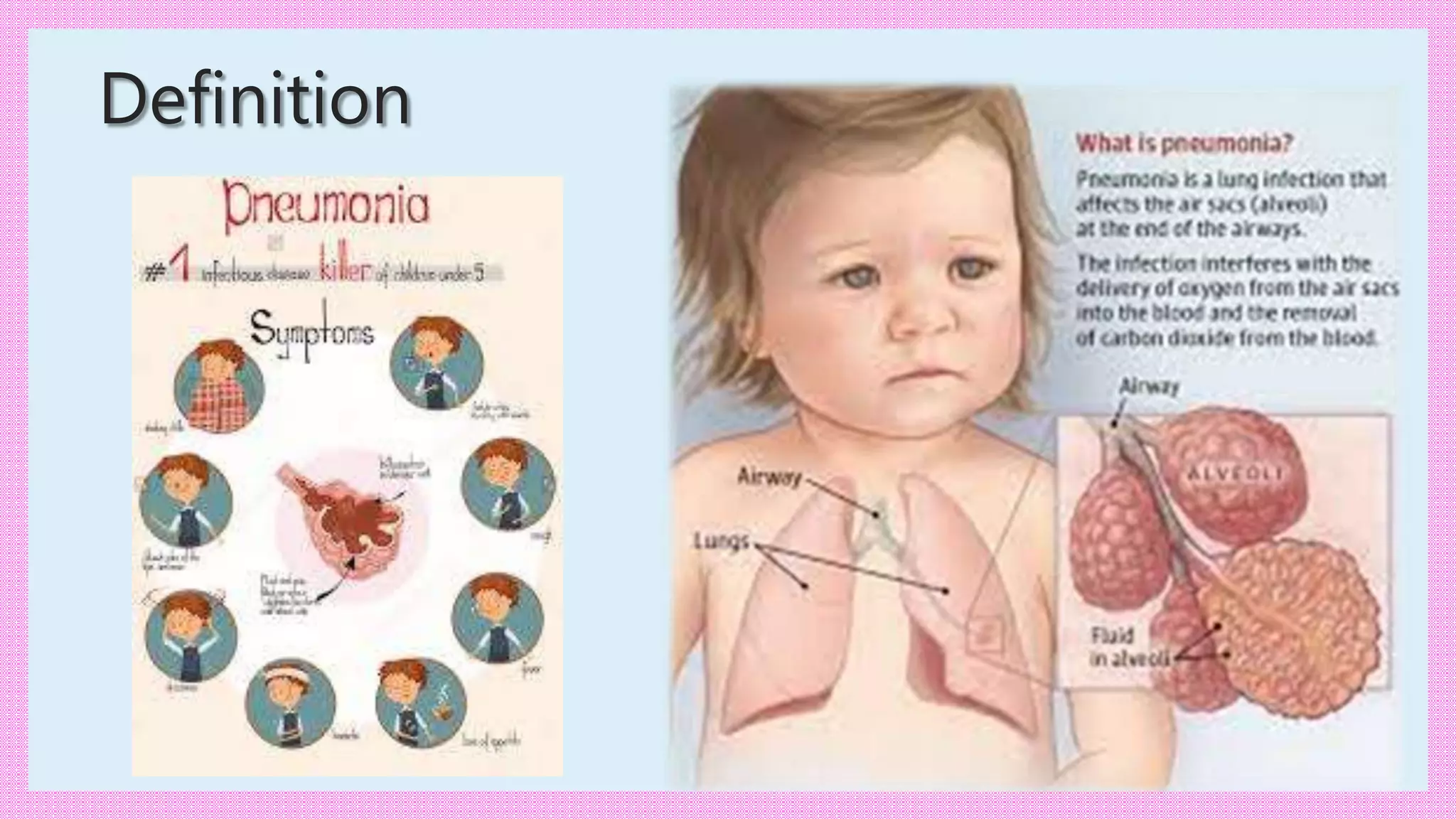 Pediatric pneumonia sadeghpour | PPTX | Infectious Diseases | Diseases ...