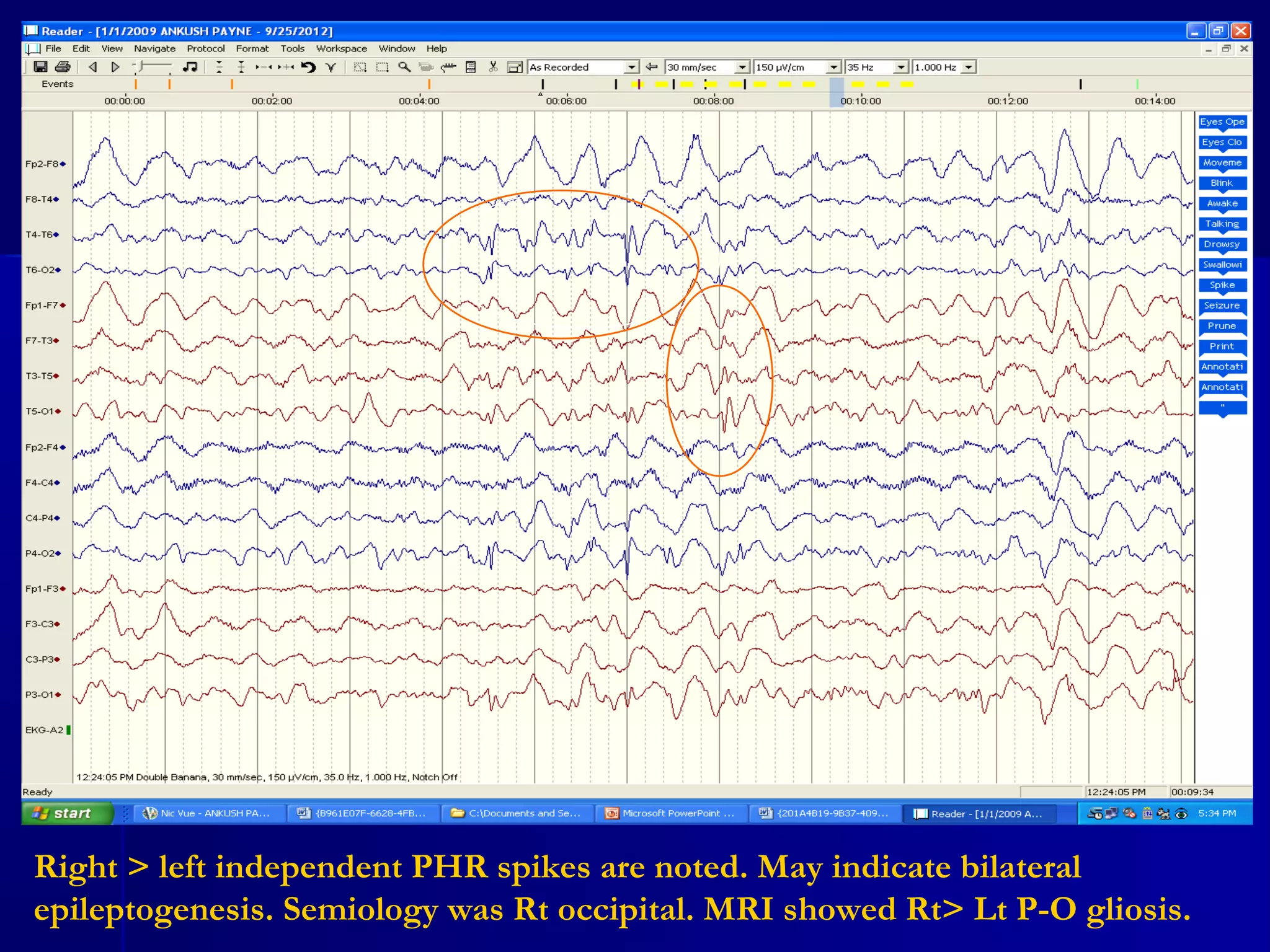 Pediatric posterior head region epilepsy | PPT