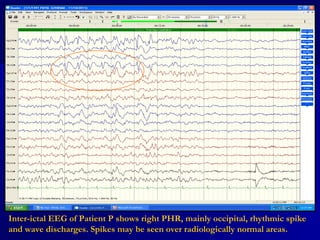 Pediatric posterior head region epilepsy | PPT