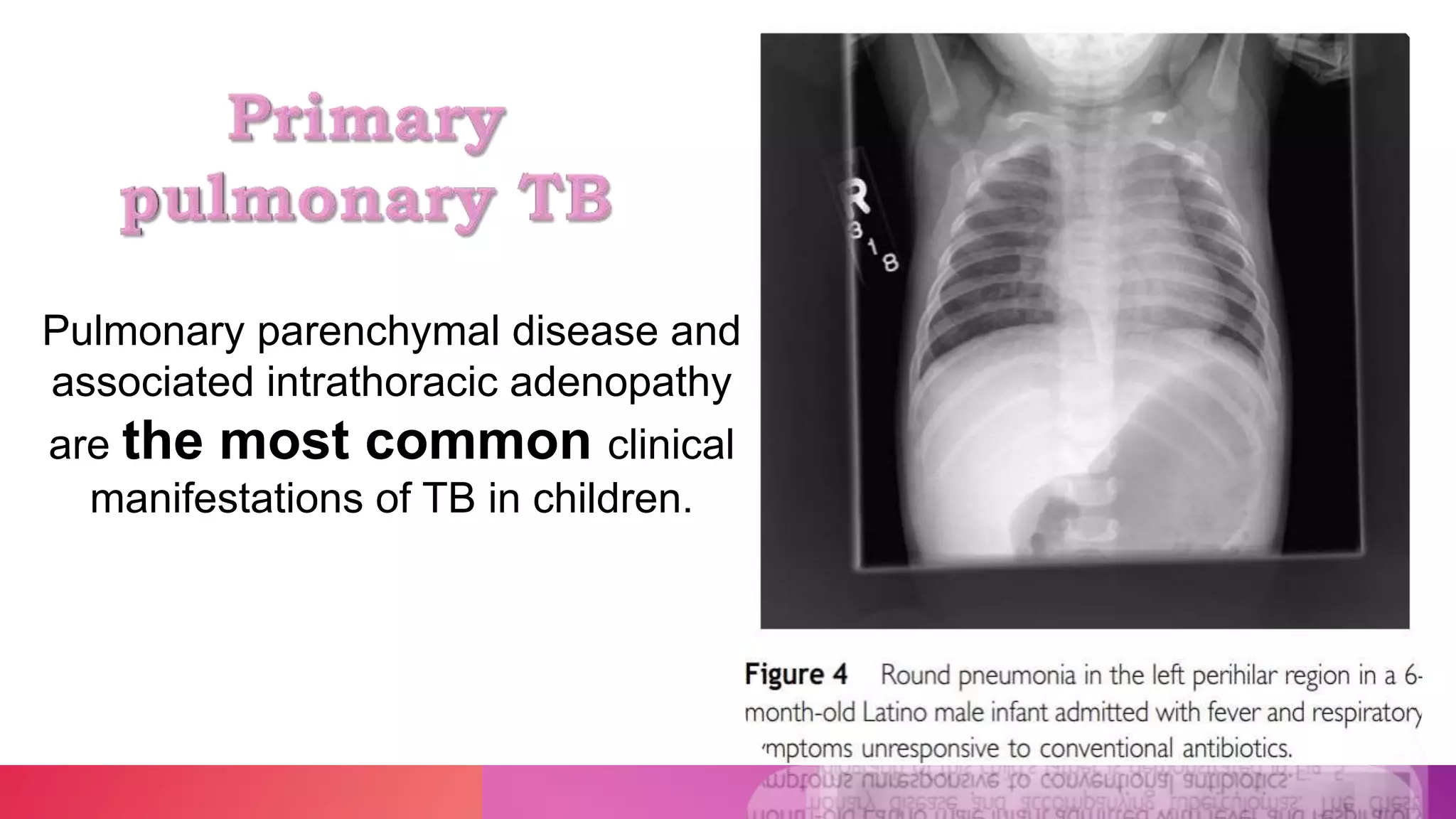 Pediatric Pulmonary Tuberculosis | PPTX