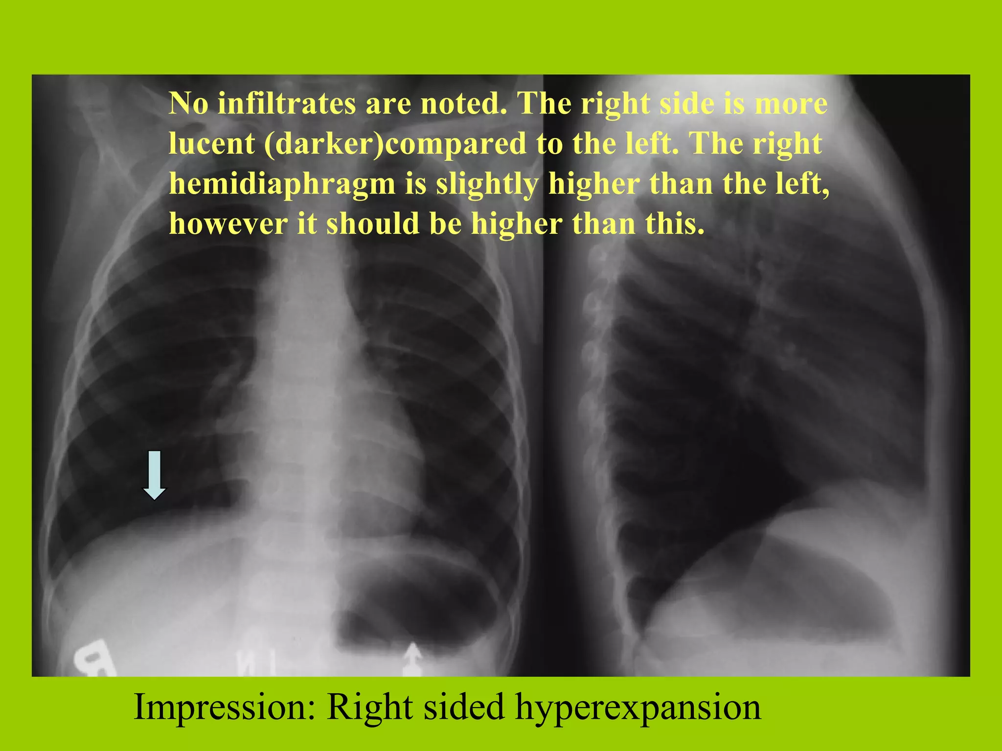 Pediatric radiology quizes chest and msk | PPT
